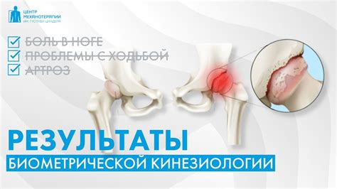 Артроз тазобедренного сустава операция и боль при ходьбе Результат работы в Центре