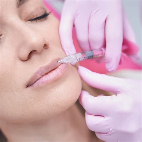 Lip Filler Treatment Escape Aesthetics Dunstable