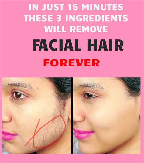 How To Remove Facial Hair Marks At Bethany Hammer Blog