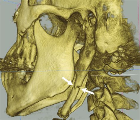 Three Dimensional Reconstruction Cone Beam Computed Tomography Image Download Scientific
