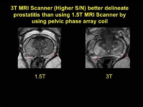 Figure 6 From Multi Parametric Mri Mp Mri In Prostate Experience And Technical Challenges