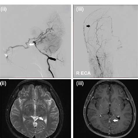 A Preoperative Selective Cerebral Dsa Showed The Presence Of
