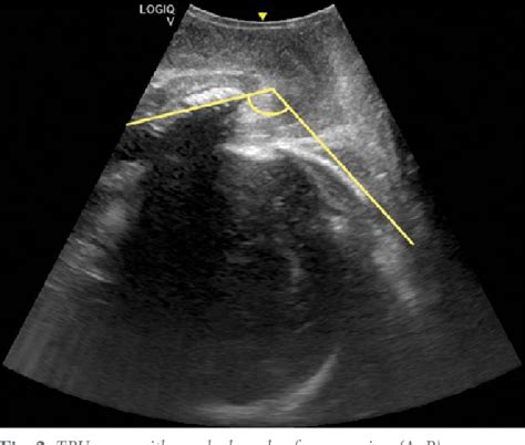 Figure 2 From Role Of Intrapartum Ultrasound In Modern Obstetrics