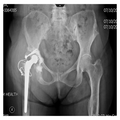 Postoperative Radiograph Status After Reduction Of Dislocated Hip Download Scientific Diagram