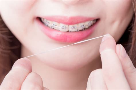 How To Floss With Braces 5 Helpful Tips Yba City Orthodontics