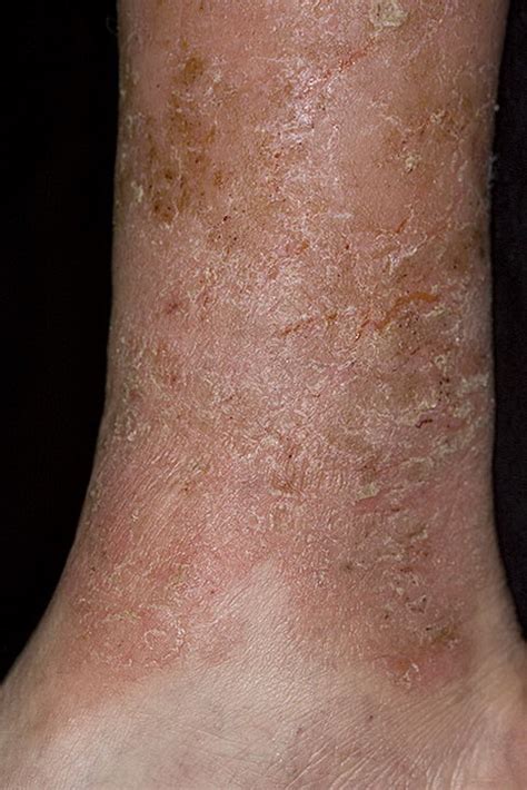 Venous Eczema On Legs Pictures 174 Photos And Images