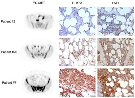 11c Methionine Pet In Multiple Myeloma Correlation With Clinical