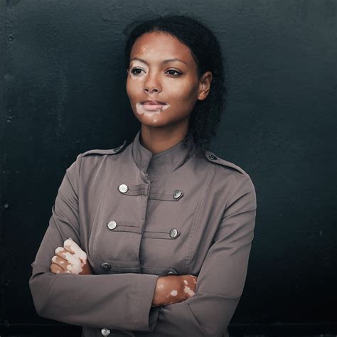 Genetic Hyperpigmentation Spotting Pigmentation Disorders Saian