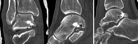 Posterior Talar Fracture With Dislocation Of Both Talo Navicular And Subtalar Joints A Variant