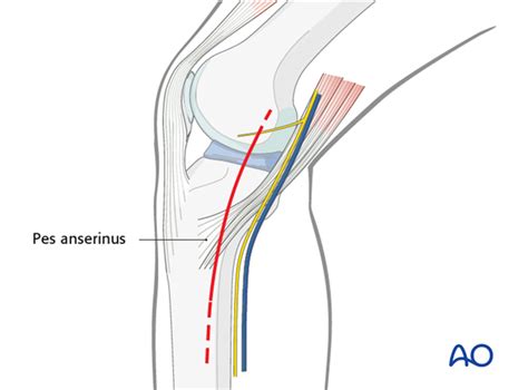 Medialposteromedial Approach To The Proximal Tibia Medialposteromedial Approach To The Proximal Tibia