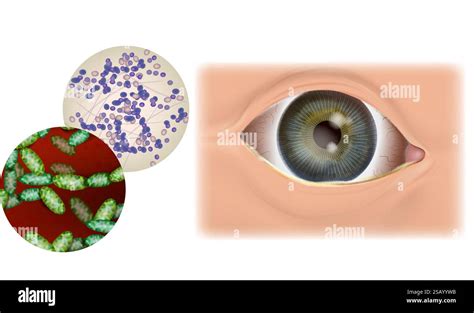 Bacterial And Viral Conjunctivitis Medical Illustration Eye Infection
