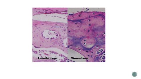 Difference Between Woven Bone And Lamellar Bone Pptx