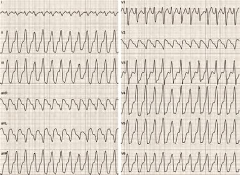 Avr Algorithm Vereckei Ecg Book