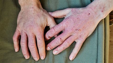 What Is Dyshidrotic Eczema Symptoms Causes Diagnosis Smartforlifereviews
