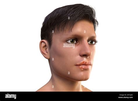 Cold Sore On The Lip Of A Man Computer Illustration Cold Sores Are