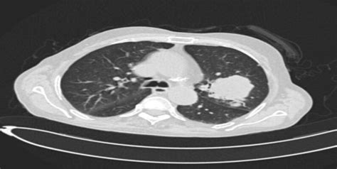 The Iq Othnccd Lung Cancer Dataset Kaggle