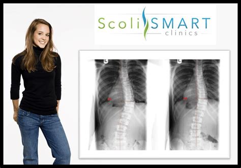 Scoliosis Progression Chart Simplified Treating Scoliosis