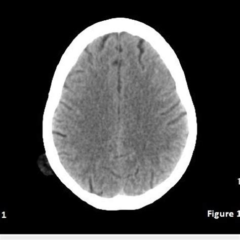 Ct Venogram Of The Head The Red Triangle Shows Normal Venous Blood
