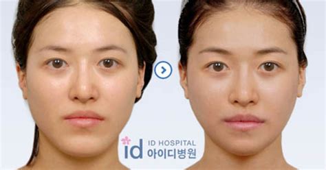 앞턱이 뭉툭해 사각형으로 보인다면 미니v라인 앞턱수술