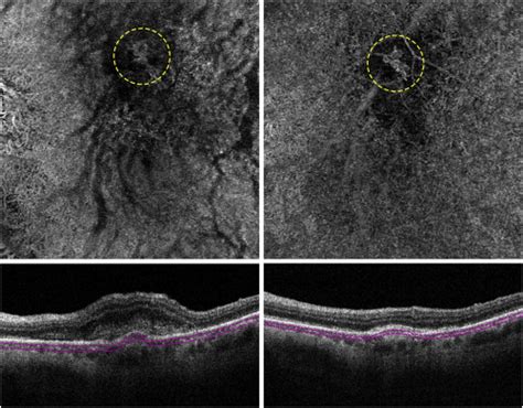 Swept Source Optical Coherence Tomography And Angiography With Download Scientific Diagram