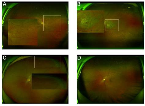 Ultra Wide Field Fundus Images Showing Typical Examples The Download Scientific Diagram