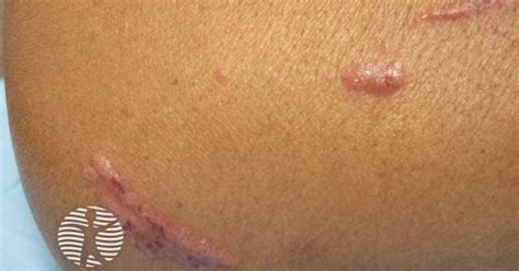 Plant Dermatitis Image Plant Dermatitis Image