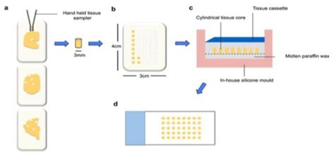 High Throughput Tissue Microarray Neurodegenerative Pathology Research Group Newcastle University