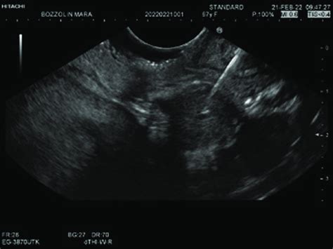 Endoscopy Biopsy Lymph Node At Douglas Byrd Blog