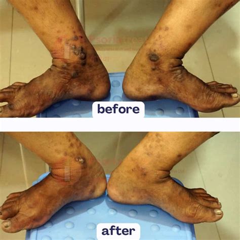 Effective Lichen Planus Treatment In Mumbai India Psoriatreat Psoriasis Treatment Using