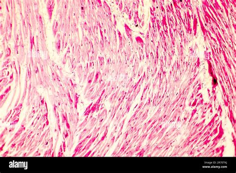 Heart Hypertrophy Photomicrograph Showing Hypertrophic Myocardium With