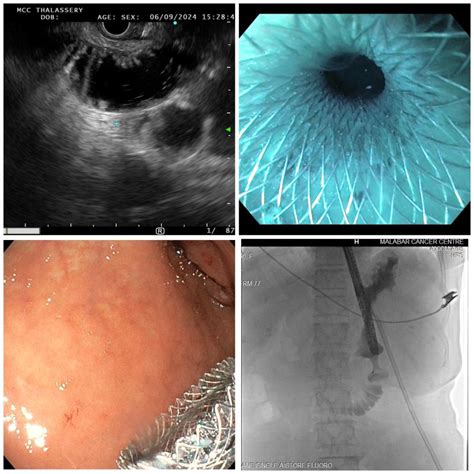Dr Jaseem Ansari On Linkedin Advancedendoscopy Endoscopicultrasound