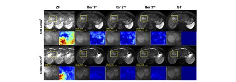 The Iterative Imcgan Reconstruction With The Tumor At The Af Of 4 The