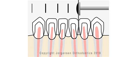 What Is Interproximal Reduction In Orthodontics Jorgensen Orthodontics Affordable Care