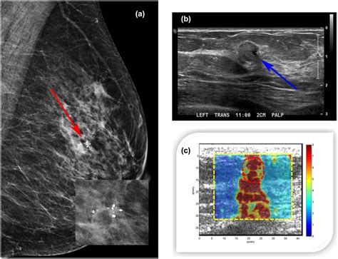 A Mediolateral Oblique Mammogram Revealing A Group Of Download Scientific Diagram