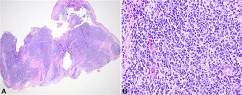 Hematoxylin And Eosin Revealed A Dense Nodular And Interstitial Download Scientific Diagram