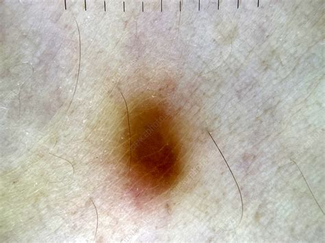 Dermatofibroma Dermoscopy Stock Image C0571908 Science Photo