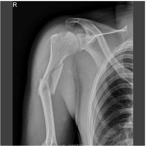 X Ray Of After Closed Reduction Download Scientific Diagram