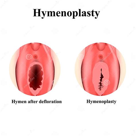 The Structure Of The Vulva Hymen Hymenoplasty Hymen After Defloration
