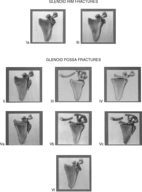 Fractures Of The Scapula Musculoskeletal Key