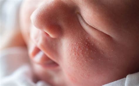 10 Possible Causes Of A Face Rash In Babies
