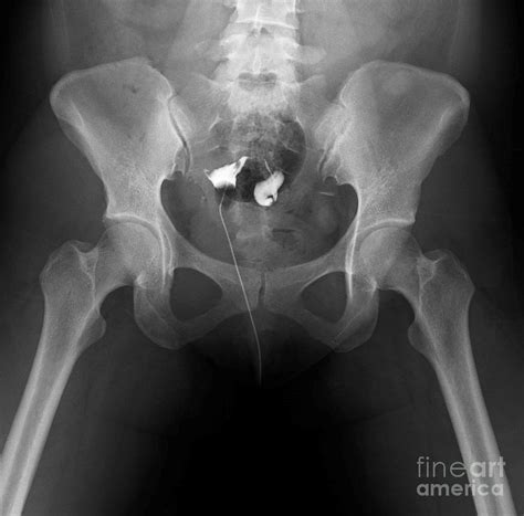 Obstructed Fallopian Tubes Photograph By Rajaaisyascience Photo