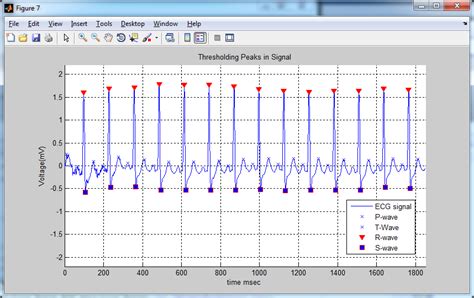 biomedical signal and image processing projects using matlab and