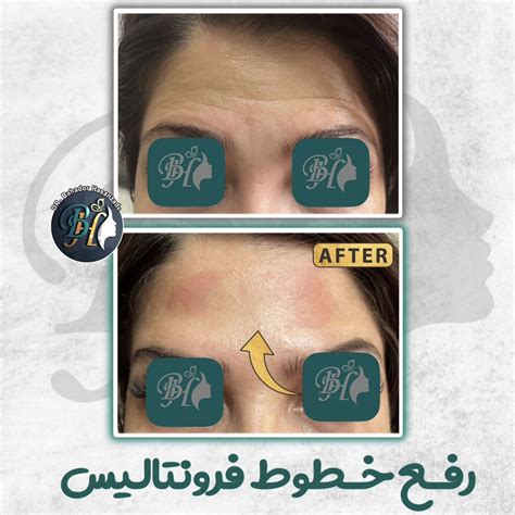 بــوتـاکـس دکتر بهادر حسن زاده پوست،مو،زیبایی
