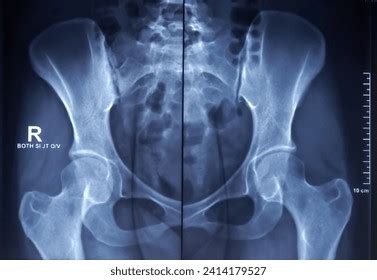 Scleroses Si Joint Royalty Free Images Stock Photos Pictures Shutterstock