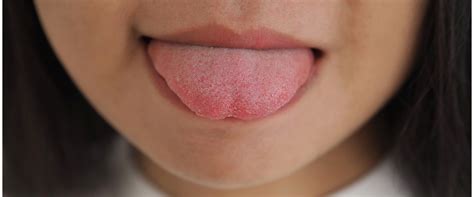 Tongue Cancer Causes And Treatment Curaprox