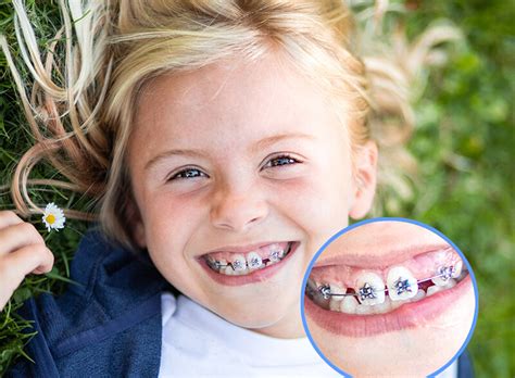 How Do Braces Work American Association Of Orthodontists