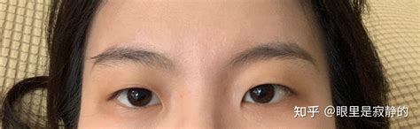 分享双眼皮全切内眦赘皮开大恢复过程～（持续更新～ 知乎