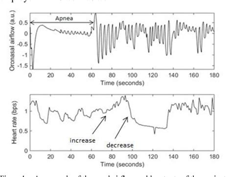Figure 1 From Sleep Apnea Detection Using Time Delayed Heart Rate