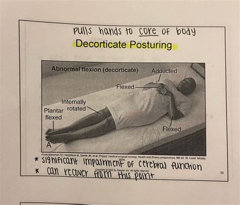 Neuro Flashcards Quizlet
