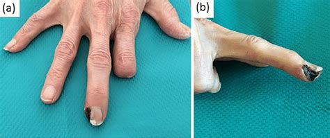 Figure1 A B Ulceration Of The Right Middle Finger And The Amputation Download Scientific